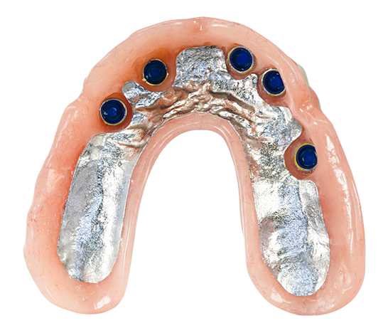 LOCATOR® Overdenture