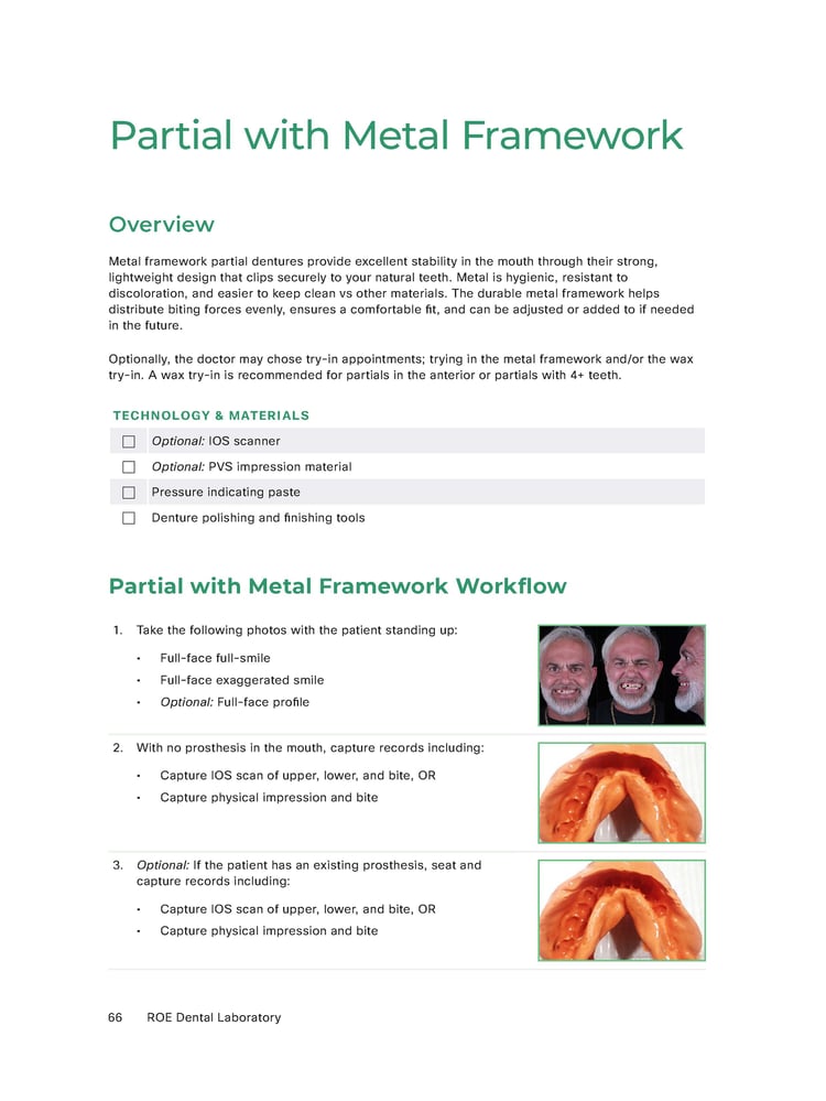 SLM Cobalt Chrome Partial Dentures