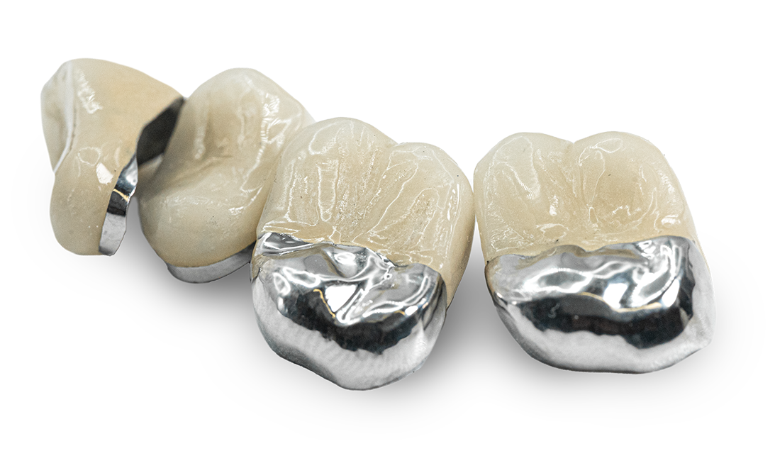 PFM (Porcelain Fused Metal)