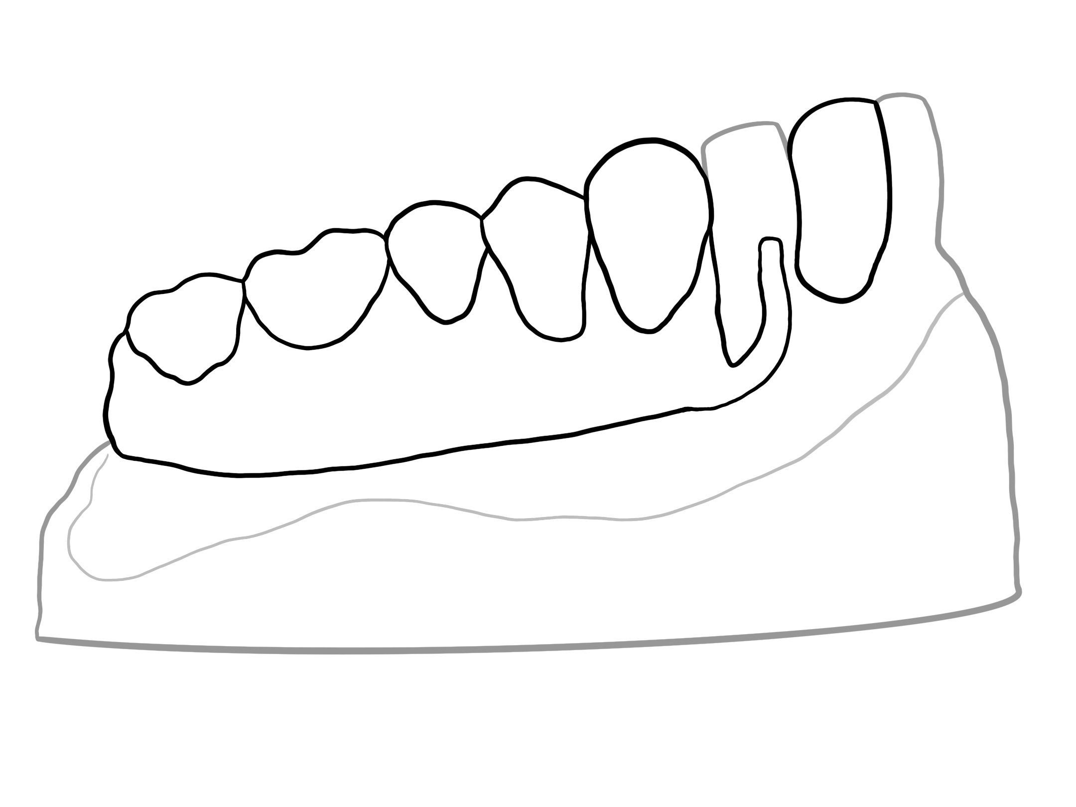 All-Acrylic Partial (Flipper)