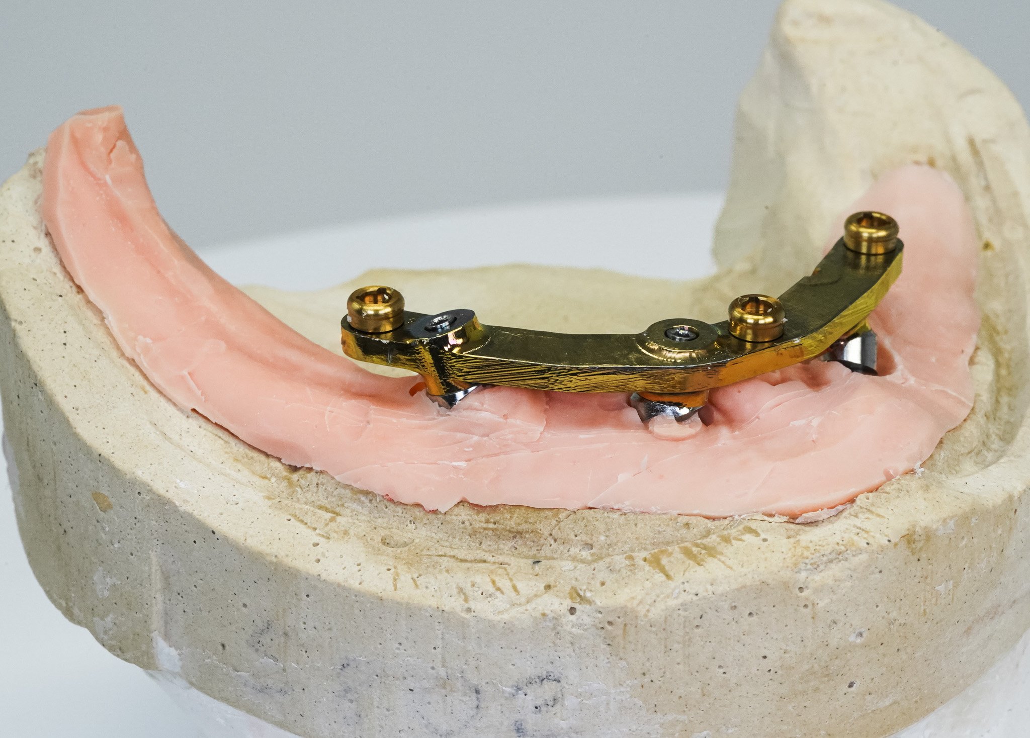 Bar Overdenture
