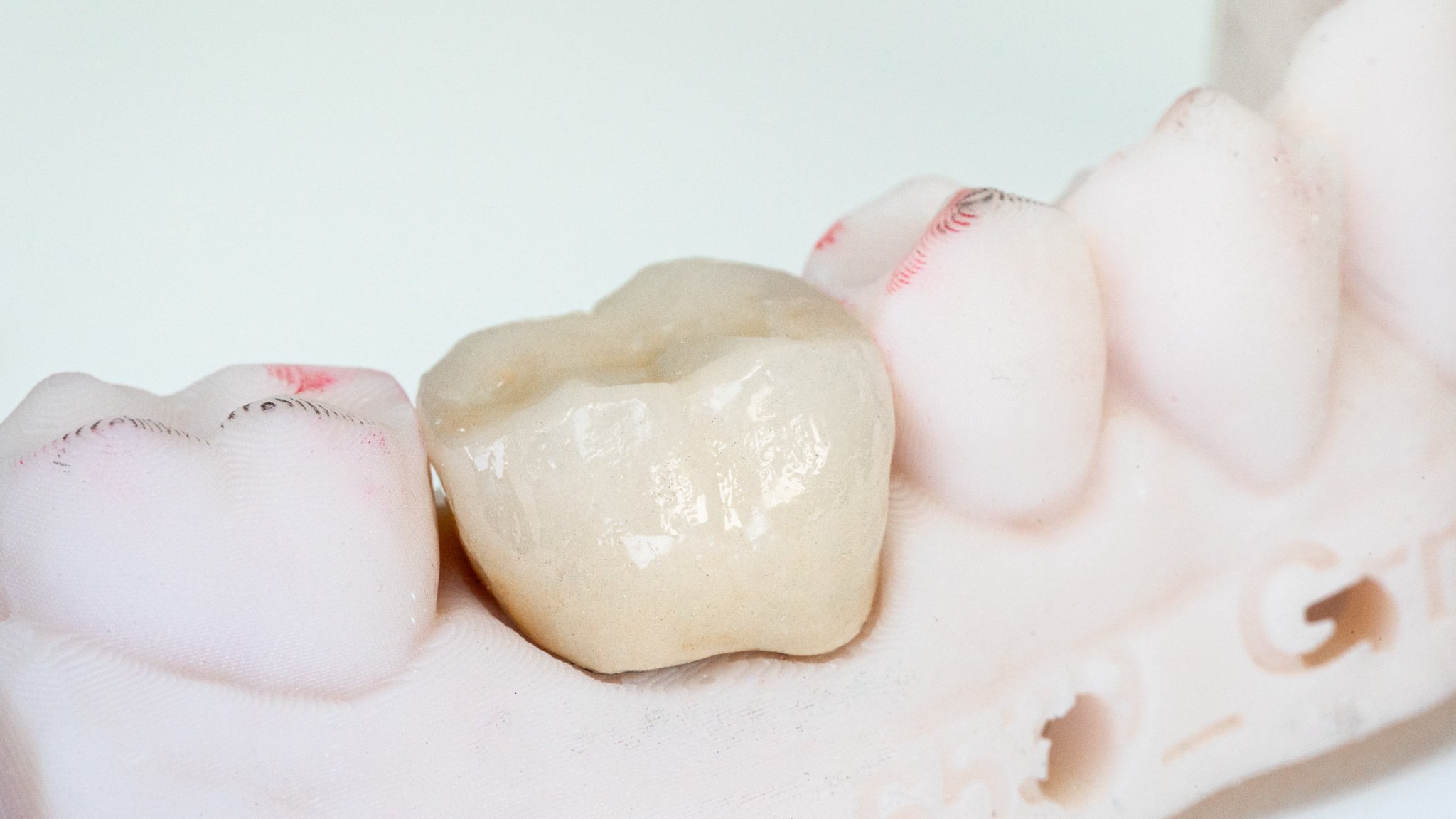 PFM (Porcelain Fused Metal)