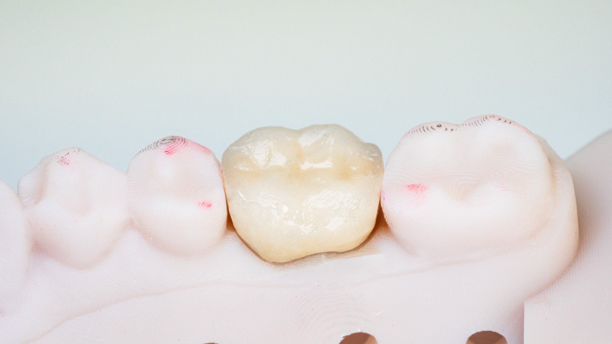 PFM (Porcelain Fused Metal)