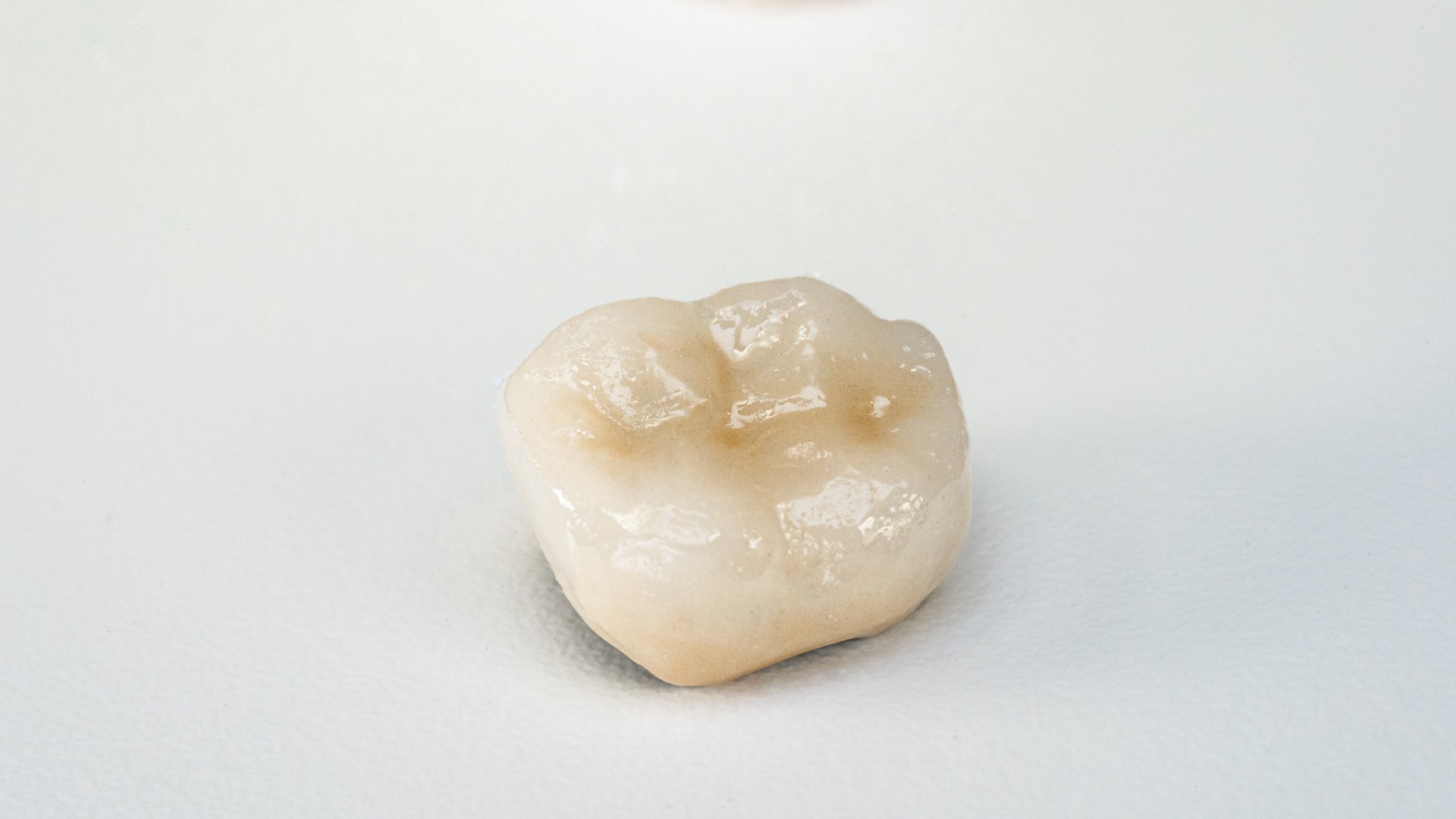 PFM (Porcelain Fused Metal)