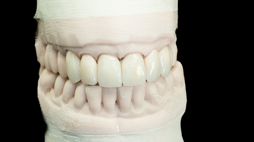 IPS e.max® Layered
