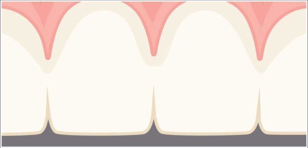 Bespoke - Teeth Options